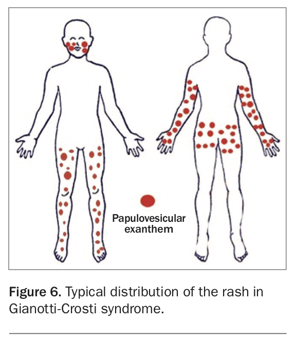 Viral exanthems: unravelling viral rashes | Medicine Today Viral exanthems: unravelling viral rashes | Medicine Today